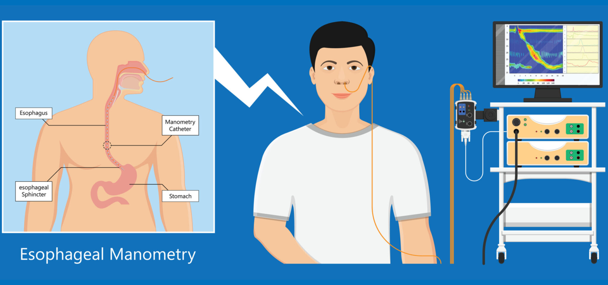 OESOPHAGEAL MANOMETRY - The Gastro Clinic