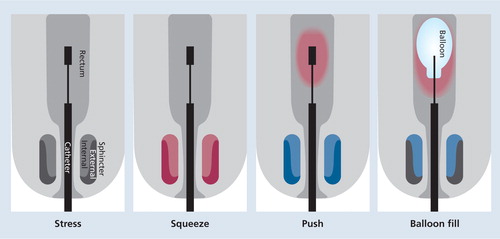 Anorectal Manometry - The Gastro Clinic